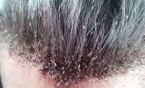 This Could Be The Most Extreme Head Lice Infestation And It Will Make Your Skin Crawl