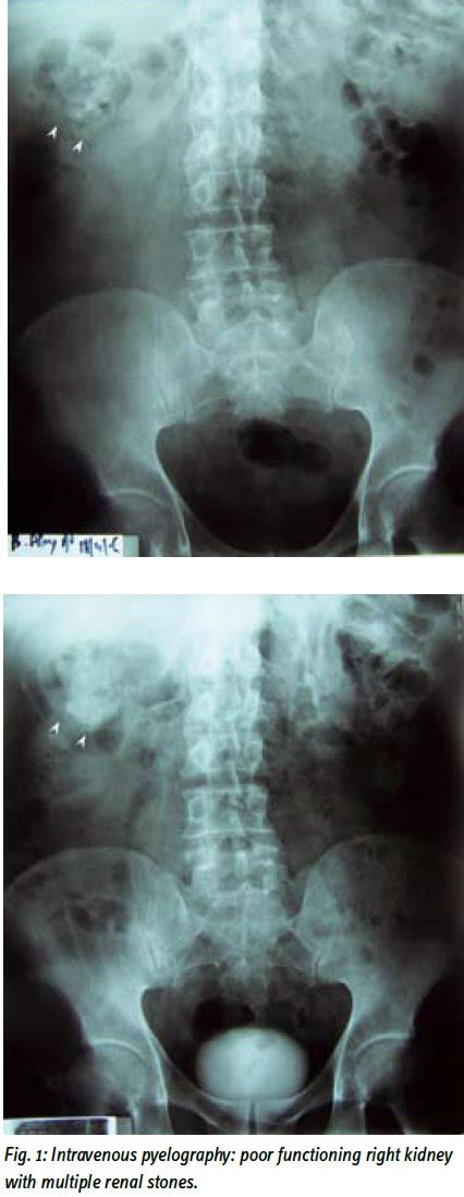 Renal Cancer Blog Pseudo Tumoral Xanthogranulomatous Pyelonephritis