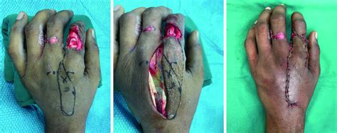 A Transposition Flap Based On Dorsal Metacarpal Artery Corresponding To Download Scientific