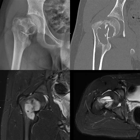 Pediatric Pathologic Fracture Pediatric Radiology Reference Article Pediatric Imaging