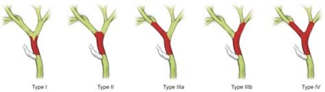 Cholangiocarcinoma The Operative Review Of Surgery