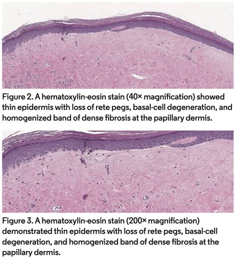 Lichen Sclerosis Histology