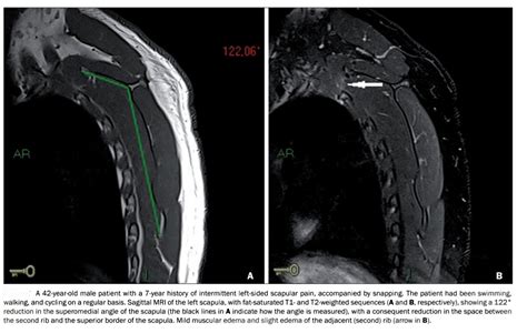 Dr Omid Bandarchi M D On Twitter 🛑 Comment For Tweet Of Snapping Scapula Theres An Arc Of