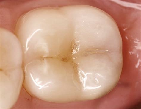 Kleinste Teilchen Für Höchste Wirkung Fissurenversiegelung Mit Grandio Seal Dental Spiegel