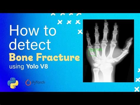 Free Video Detecting Bone Fractures Using Deep Learning And YOLOv Object Detection Tutorial