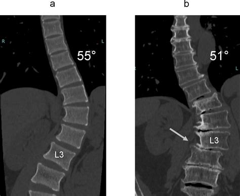 Figure 1 From Risk Factors For Lateral Translation In Residual