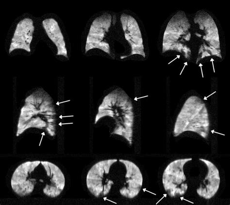 Hyperpolarized Gas Mri In Pulmonology Pmc