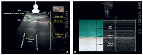 A Pulmonary Ultrasound Image Obtained With A Convex Transducer In The Download Scientific