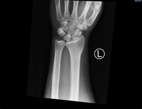 Druj Wrist Xray Ap Unannotated Jetem 2020 Jetem