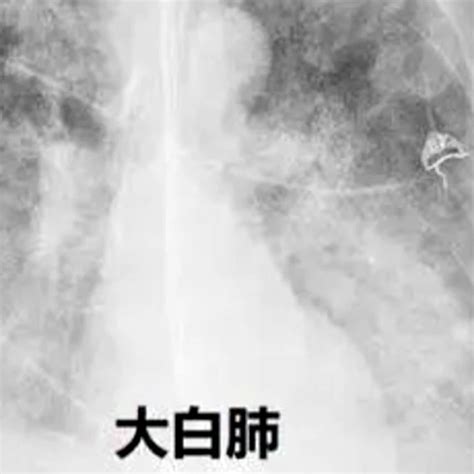 “阳”了后担心“白肺”？到底什么情况需要拍ct？专家提醒→新冠肺炎新浪新闻