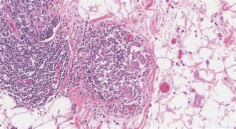 Chronic Ileitis Atlas Of Pathology