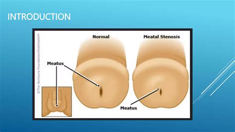 Distal Urethral Stricturepptx