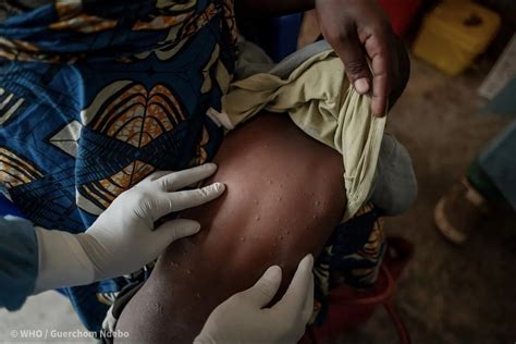 Virtual Sex Only Doh Clarifies Advice On Avoiding Mpox Abs Cbn News