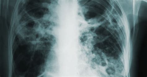 How Ai Powered Pneumonia Detection Revolutionises Indian Healthcare