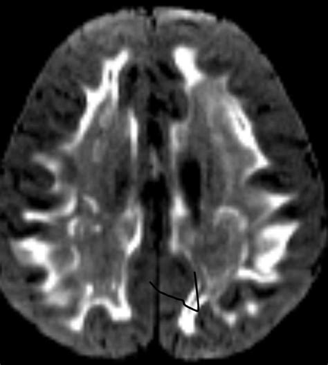 Spin Academics On Linkedin Tip Of The Day 💡 Diffusion Restricting