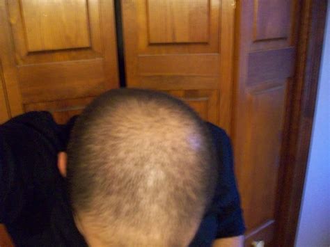 24 Years Olddiffuse Balding Hairlosstalk Forums