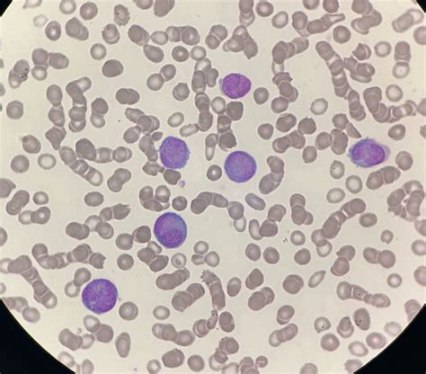 Setareh Sheikhi On Linkedin Promyelocytes In Microgranular Variant Of M3 Aml The Microgranular…