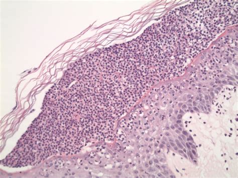 Generalized Pustular Psoriasis Treated With Risankizumab Mdedge
