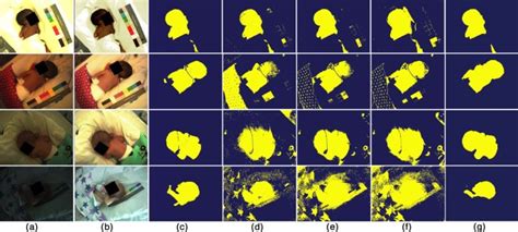 Non Contact Physiological Monitoring Of Preterm Infants In The Neonatal