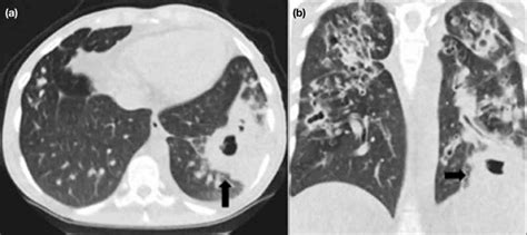 Ultra Low Dose Computed Tomography Using Model Based Iterative Download Scientific Diagram