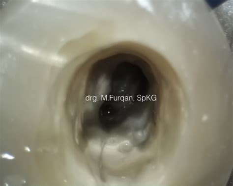 Case 2 Another Crack Tooth With C Shape Canal Perawatan Saluran Akar