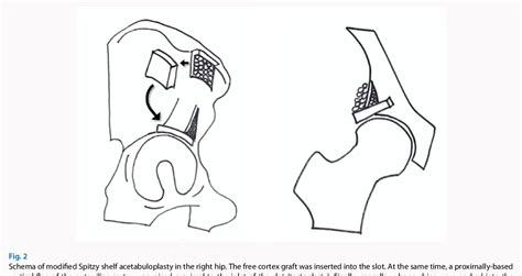 Figure 1 From The Modified Spitzy Shelf Acetabuloplasty For The Dysplastic Hip Semantic Scholar