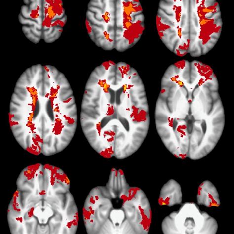 Lesion Overlap Map This Figure Shows The Anatomical Distribution And Download Scientific