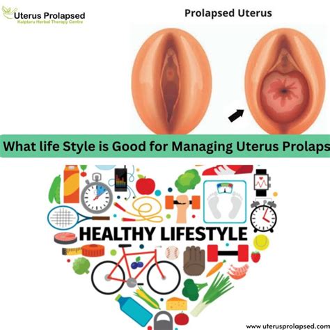 What Life Style Is Good For Managing Uterus Prolapse