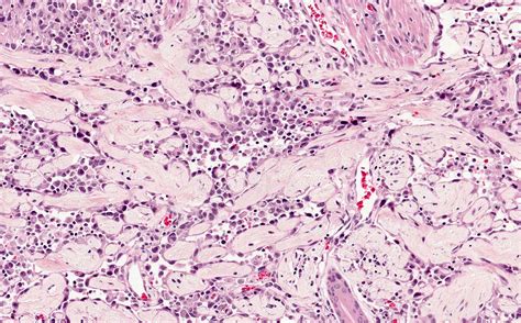 Jerad Gardner Md On Twitter 80 Yo Man With Growing Violaceous Nodule On Scalp Your Diagnosis
