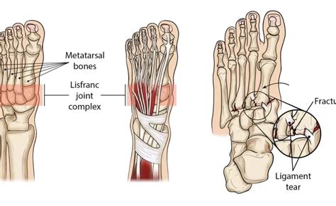 Lisfranc Dislocation Archives Samarpan Physiotherapy Clinic