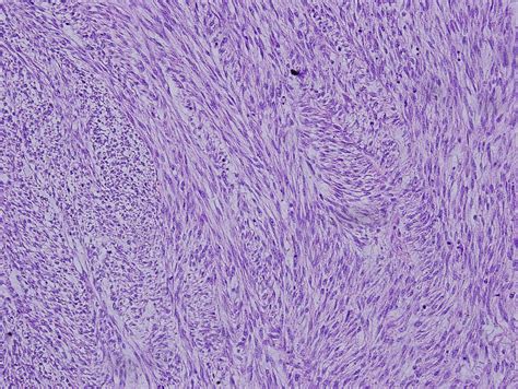 Pathology Outlines Leiomyosarcoma