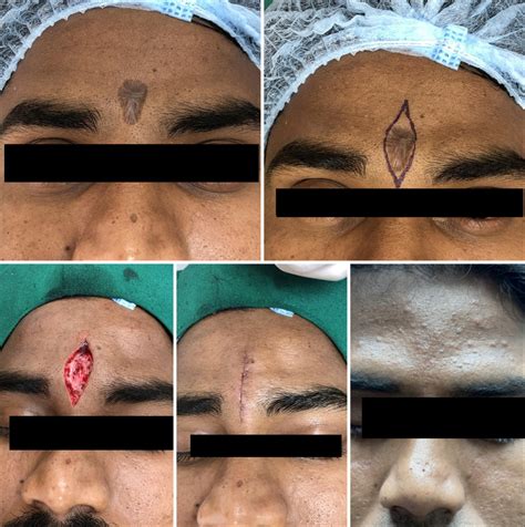 Exploring Surgical Outcomes Of Elliptical Excision Against Relaxed Skin Tension Lines On The