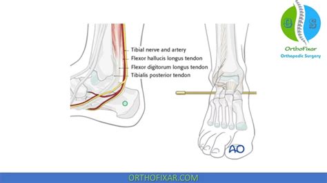 Skeletal Traction Types And Indications Orthofixar