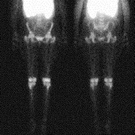 Technitium 99m Sulfur Colloid Scan Anterior A And Posterior B
