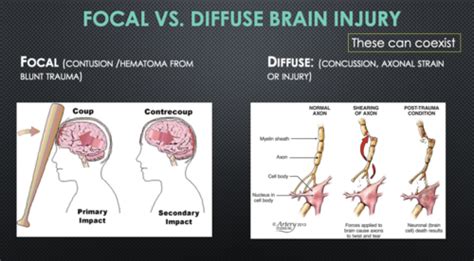 Head Injuries And Brain Tumours Flashcards Quizlet
