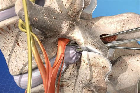 Minimally Invasive Decompression Executive Spine Surgery