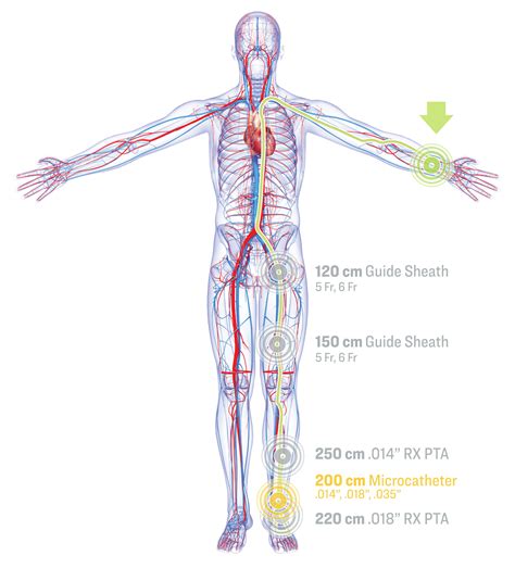 Sublime™ Microcatheter — Sublime™ Radial Access Platform