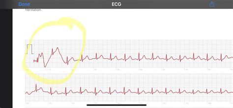 Weird Start To My Ecg What Is This Highlighted In Yellow Recg