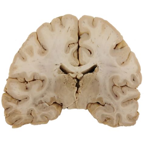 Cut Through The Lateral Geniculate Nucleus Diagram Quizlet