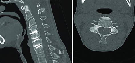 Sagittal Reconstructed And Axial Computed Tomography Showing C4 5