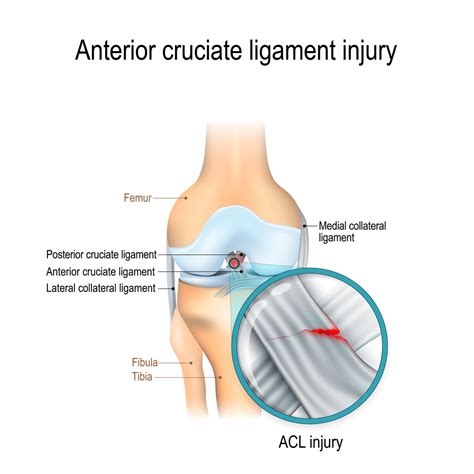 Common Basketball Knee Injuries