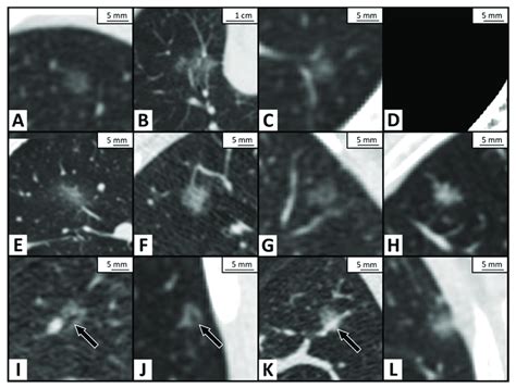 The Illustration Of Imaging Characteristic Of The Pure Ground Glass Download Scientific Diagram