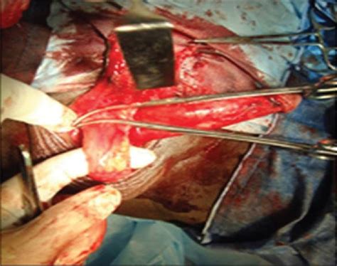 Application Of Embryonic Equivalents In Male To Female Sex Reassignment