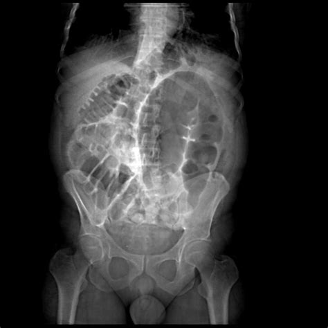 Sigmoid Volvulus Coffee Bean Sign