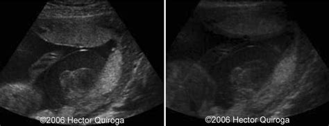 📃 Subamniotic Hematoma