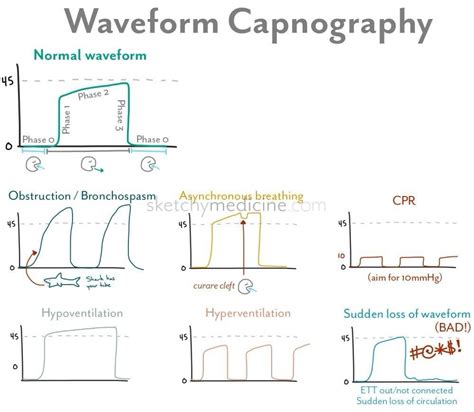 Wesam Saleh On Linkedin Waveform Capnography