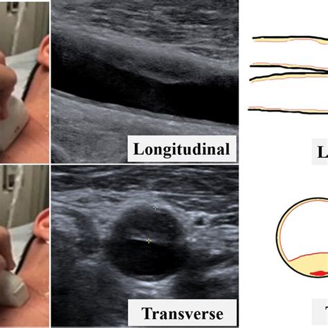 carotid ultrasound imaging and carotid plaque thickness cpt