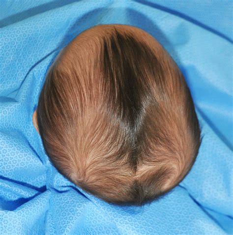 Lambdoid Synostosis Facts And Photos Craniosynostosis