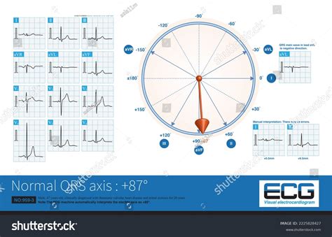 61 Left Axis In Ecg 图片、库存照片和矢量图 Shutterstock