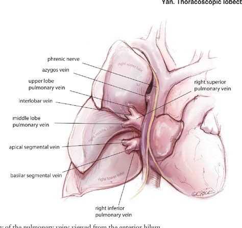 Right Upper Lobectomy Technique